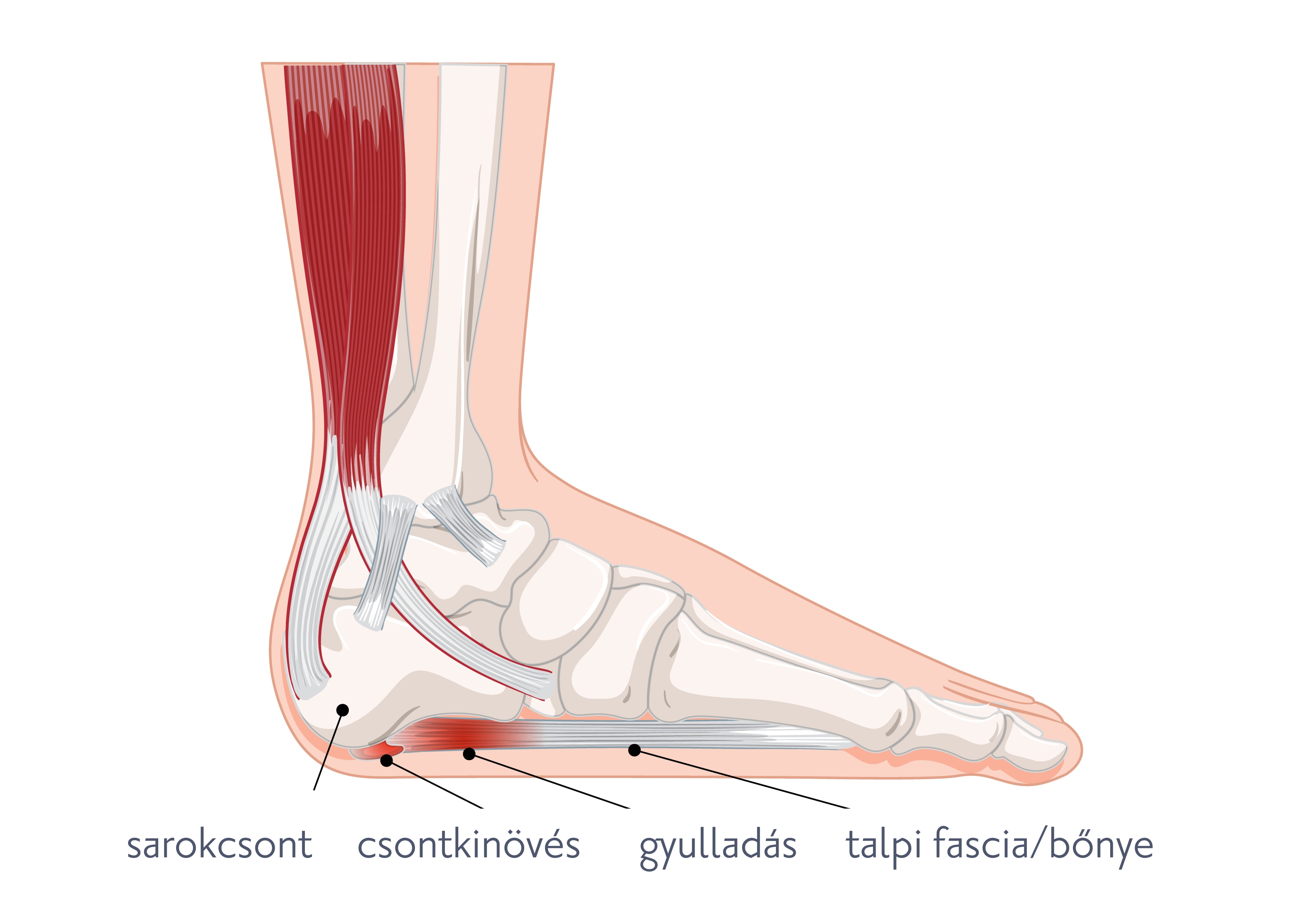 Talpi bőnyegyulladás (plantar fasciitis)