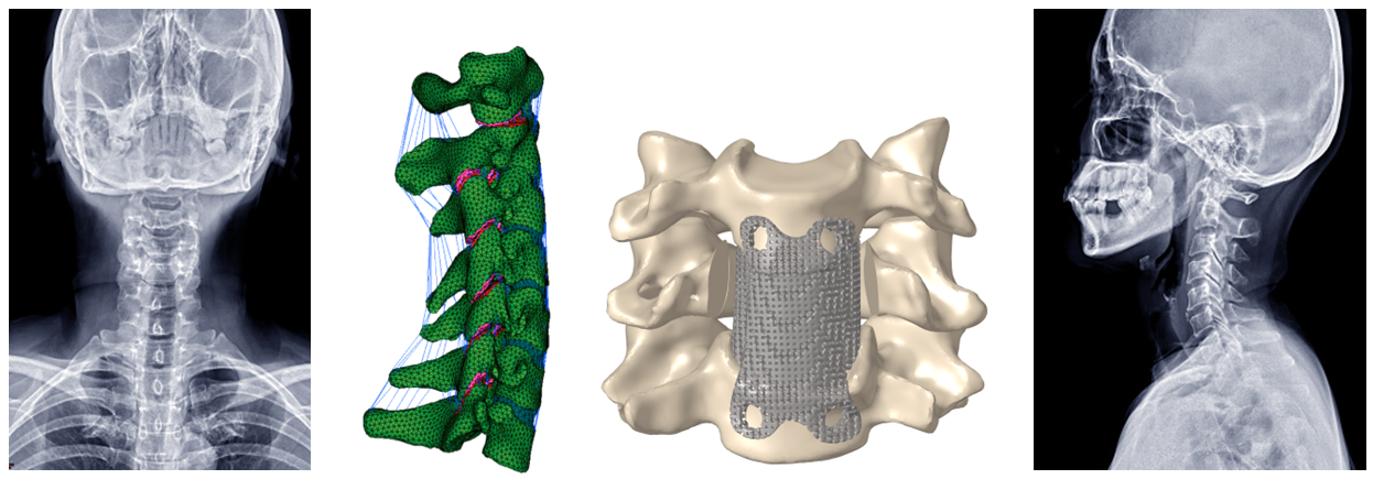 Számítógépes modellek a gerincgyógyászatban