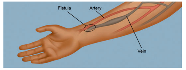 AC shunt/Cimino fistula képzése